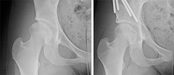 New study published by Washington University Orthopedics supports PAO ...