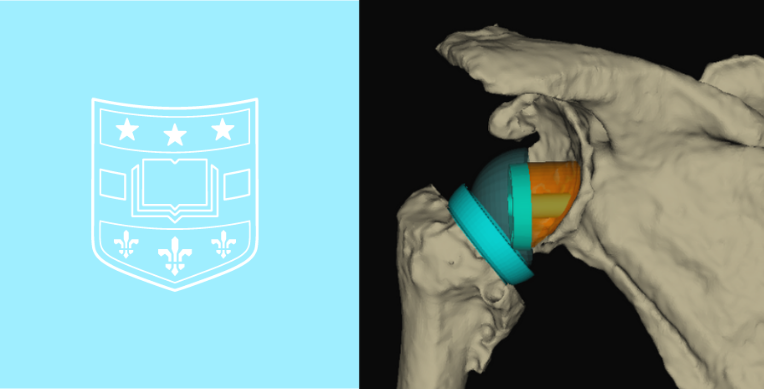 3D Visualization Technology for Enhanced Shoulder Replacements
